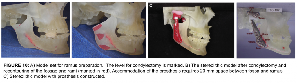 Total Temporomandibular Joint (TMJ) Replacement - Larry M. Wolford, DMD