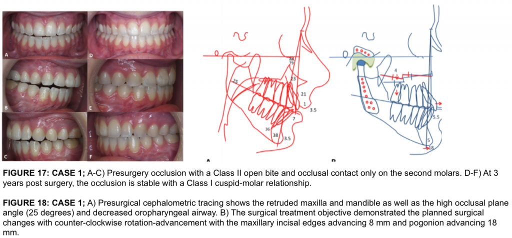 Total Temporomandibular Joint (TMJ) Replacement - Larry M. Wolford, DMD