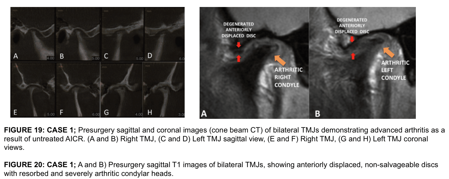 Total Temporomandibular Joint (TMJ) Replacement
