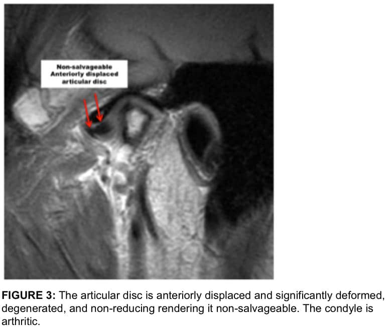 Total Temporomandibular Joint (TMJ) Replacement