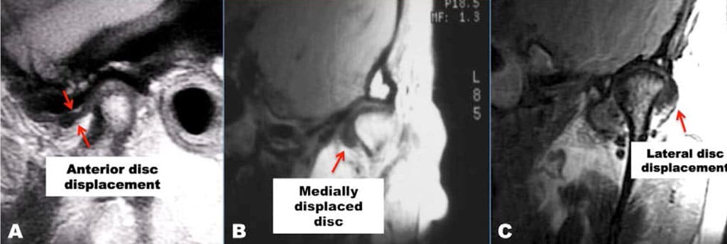 MRI-disc-TMJ - Larry M. Wolford, DMD