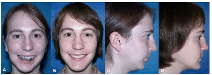 TMJ Reactive Arthritis | Dr. Larry M. Wolford, DMD