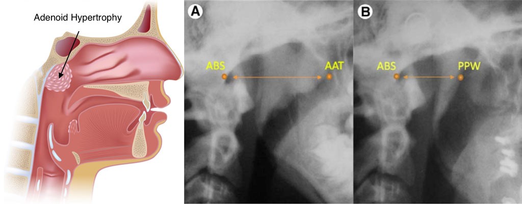 Hyperplastic adenoid tissues