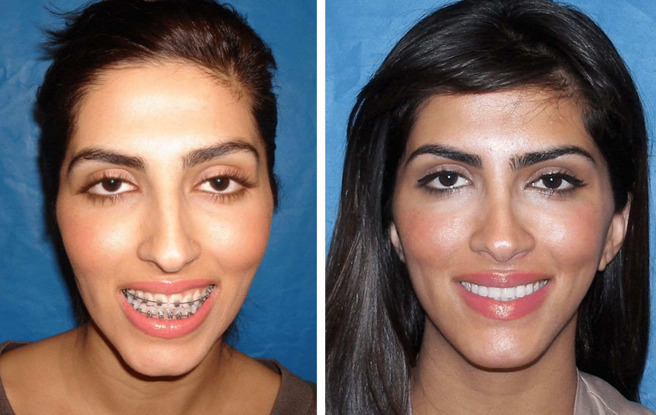 Before & After Case 17 Facial Asymmetry surgery - Larry M. Wolford, DMD