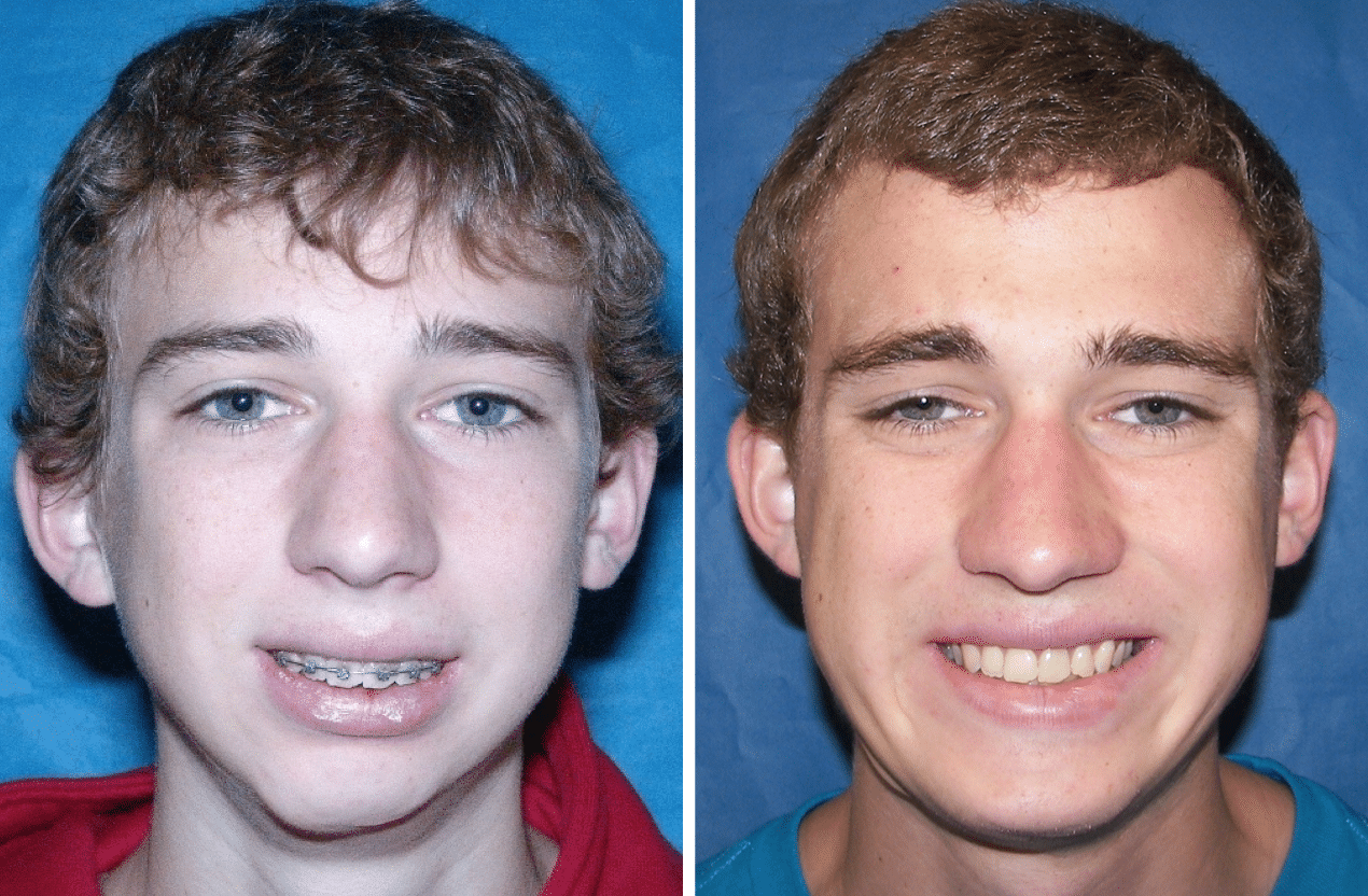 Braces For Tmj Before And After at Charles Braim blog