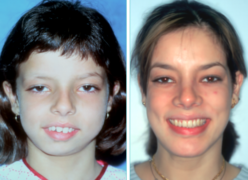 Before & After Case 22 hemifacial microsomia surgery - Larry M. Wolford ...