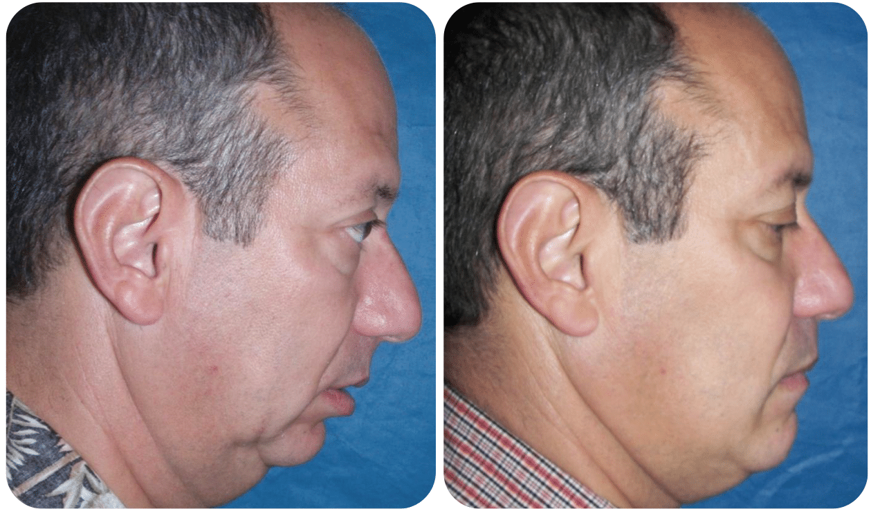 Before & After Case 2b Sleep Apnea Surgery