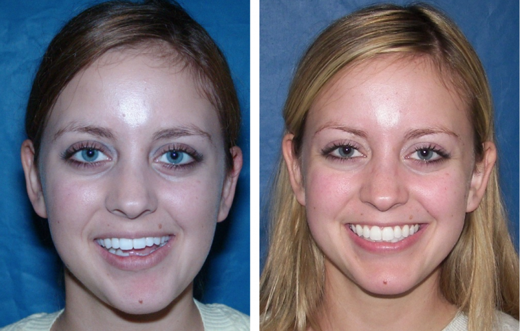 Before & After Case 5 Int Condylar Resorp - Larry M. Wolford, DMD