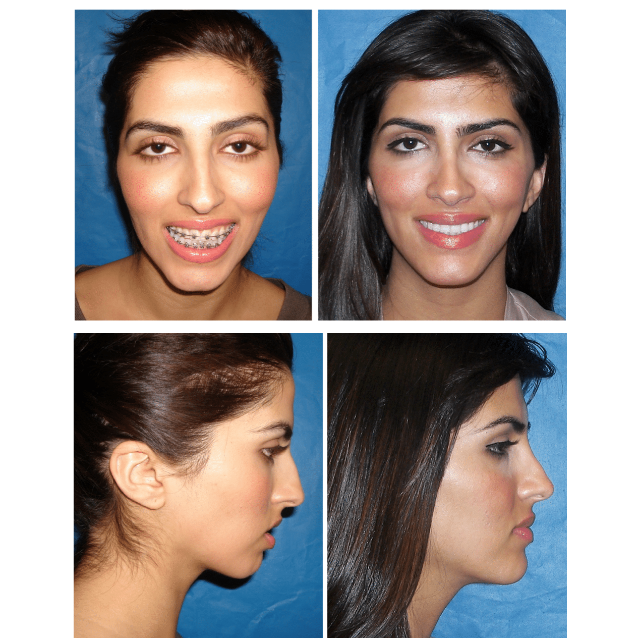 Before and After Photos Maxillofacial Surgery - Larry M. Wolford, DMD